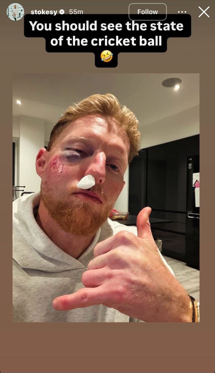 Ben Stokes suffers BRUTAL face injury; Know how he got injured